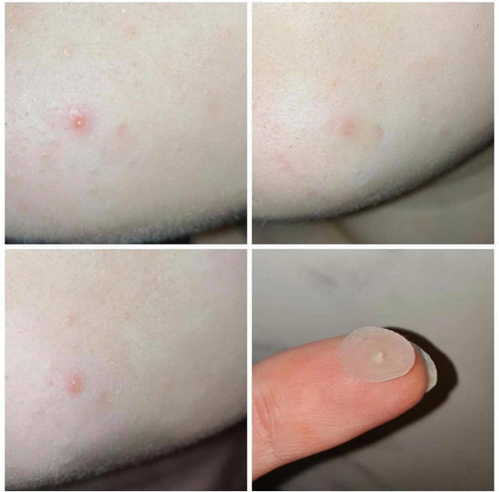 Jelly Ko Jelly Shield Pimple Patches – jellyko